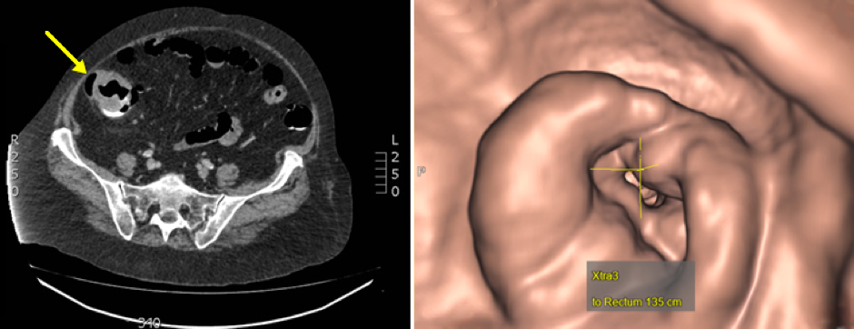 New CT colonography e-learning sessions | SoR