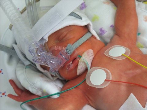 NICE issues new guidelines on preterm labour and birth | SoR
