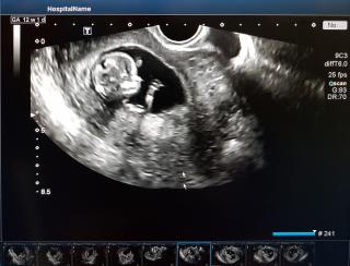 Saving Babies’ Lives Care Bundle v2 update | SoR