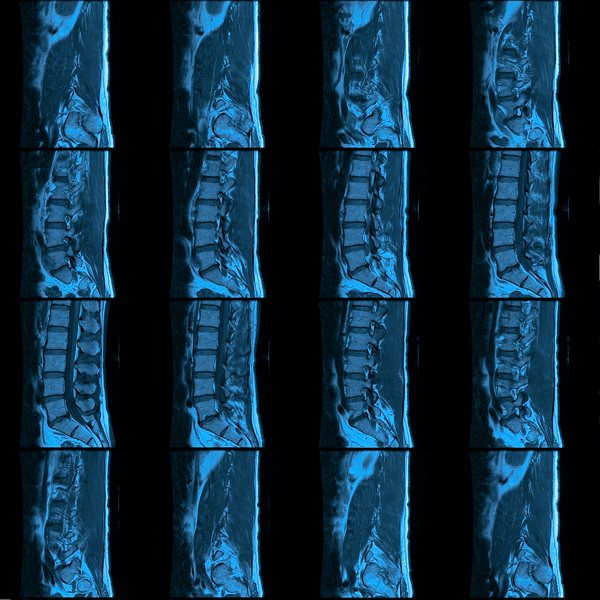 New national pathway launched for Cauda Equina Syndrome | SoR